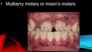 Oral manifestation of syphilis | PPTX