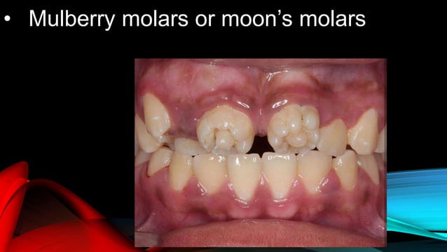 Oral manifestation of syphilis | PPTX