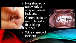 Oral manifestation of syphilis | PPTX