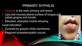Oral manifestation of syphilis | PPTX