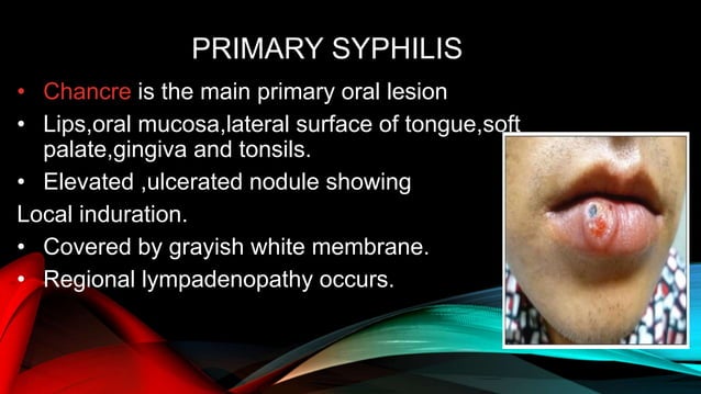 Oral manifestation of syphilis