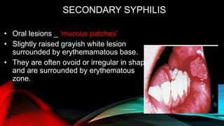 Syphilitic Glossitis
