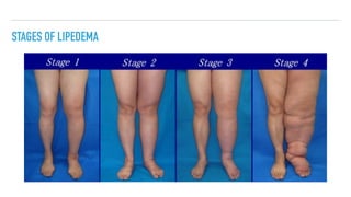 Lipedema | PDF