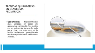 MANEJO QUIRÚRGICO DEL GLAUCOMA PEDIATRICO | PPTX