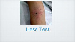 ITP : idiopathic or immune thrombocytopenic purpure | PPTX | Blood ...