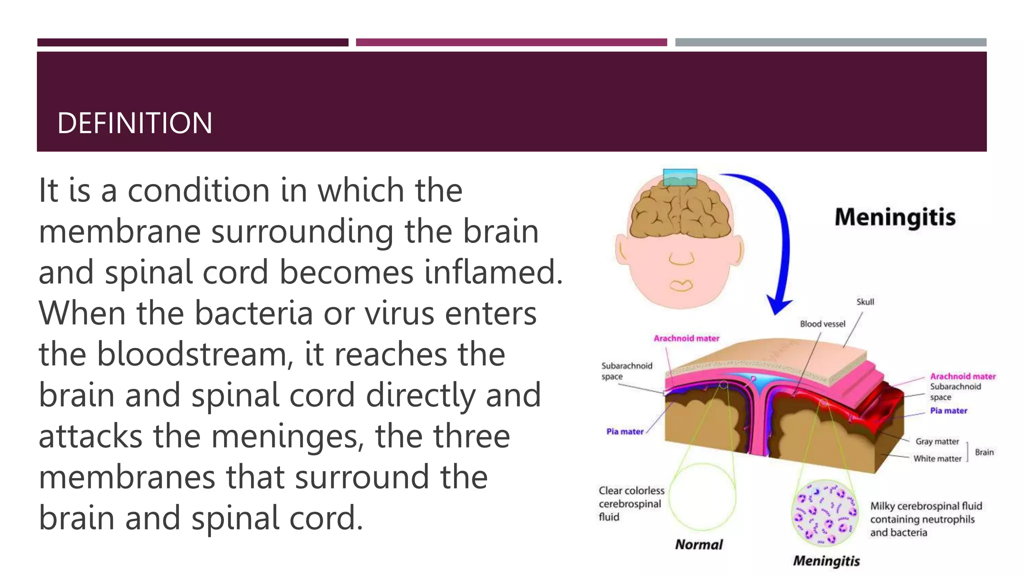 Meningitis | PPT