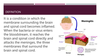 Meningitis | PPT