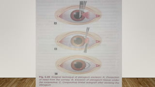 Presentation (8). Ppt on topic of ophthalmology | PPT