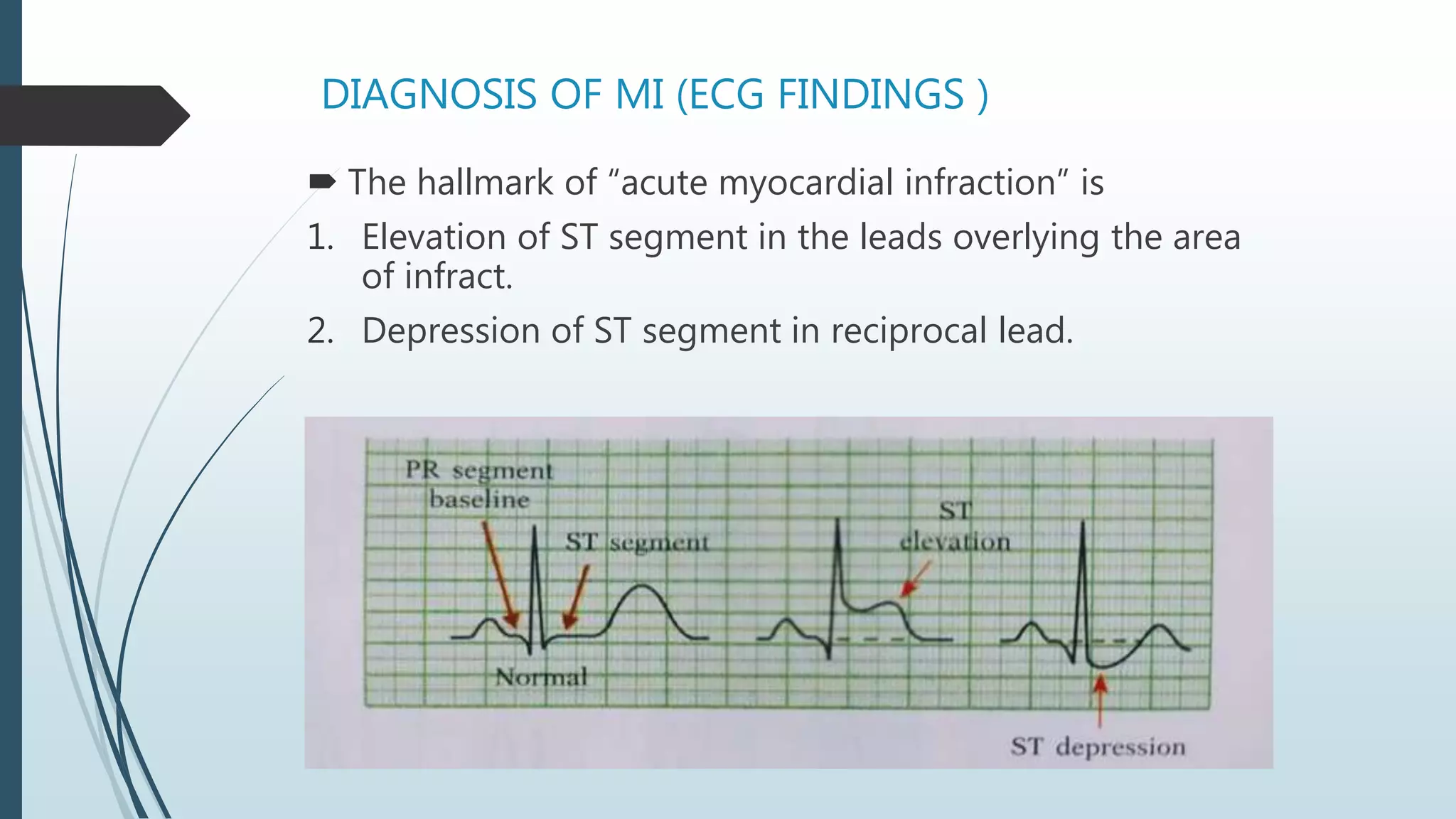 Use of ECG in myocardial infarction | PPTX