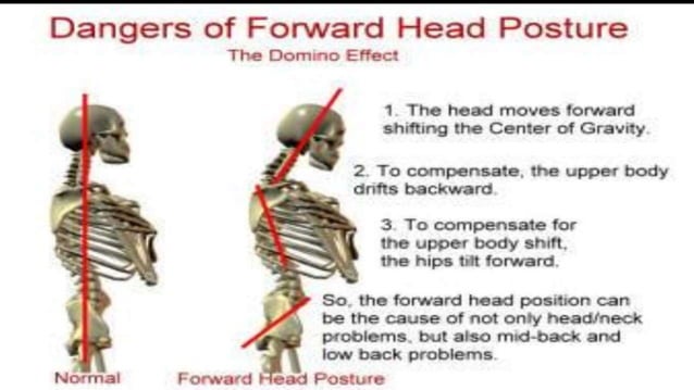 text neck deformity | PPT