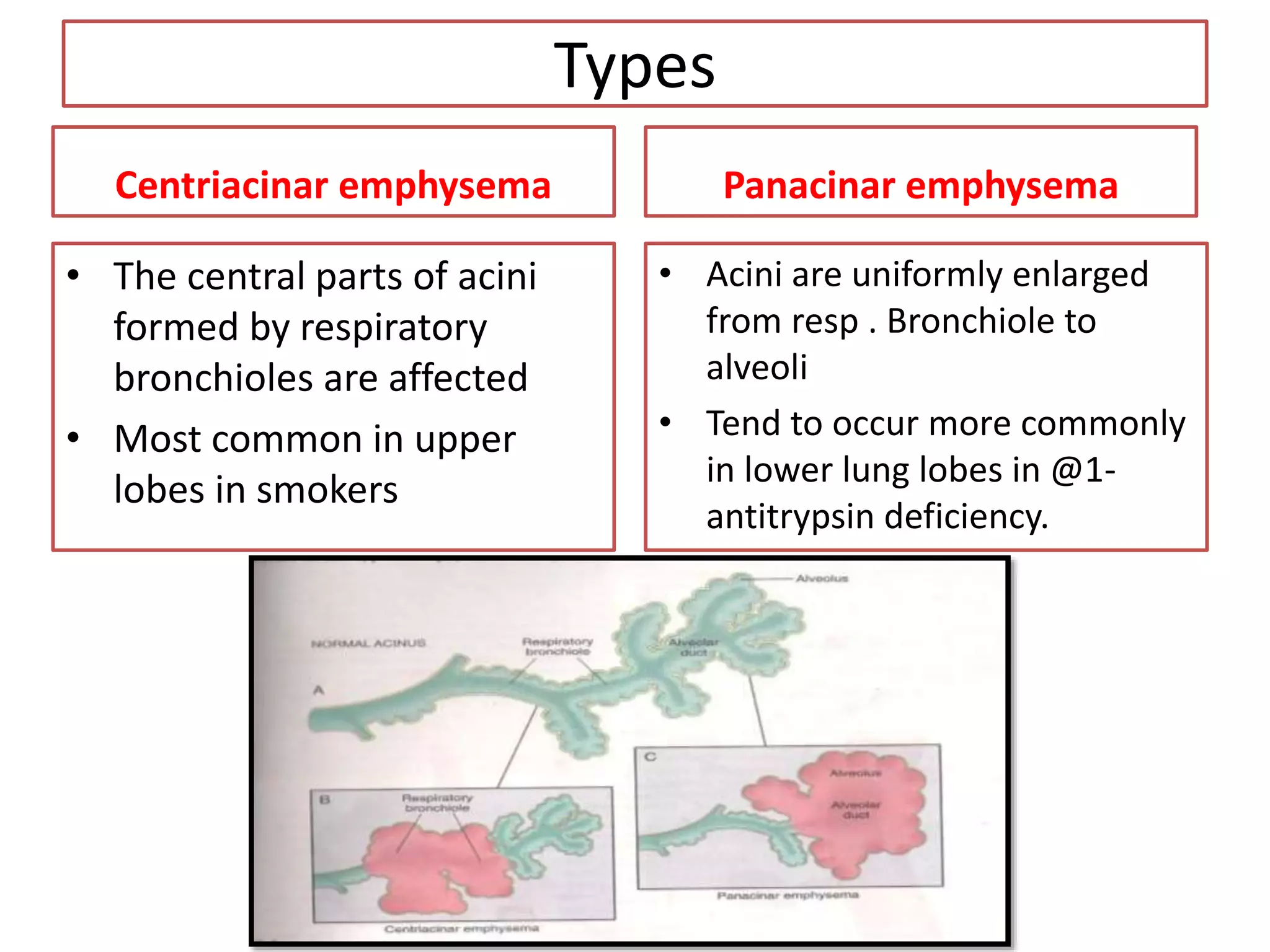 Emphysema | PPT