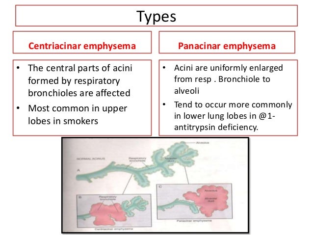 Emphysema