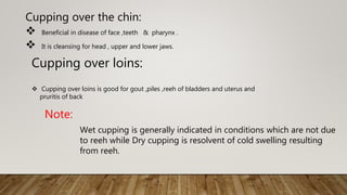 Presentation about cupping | PPTX