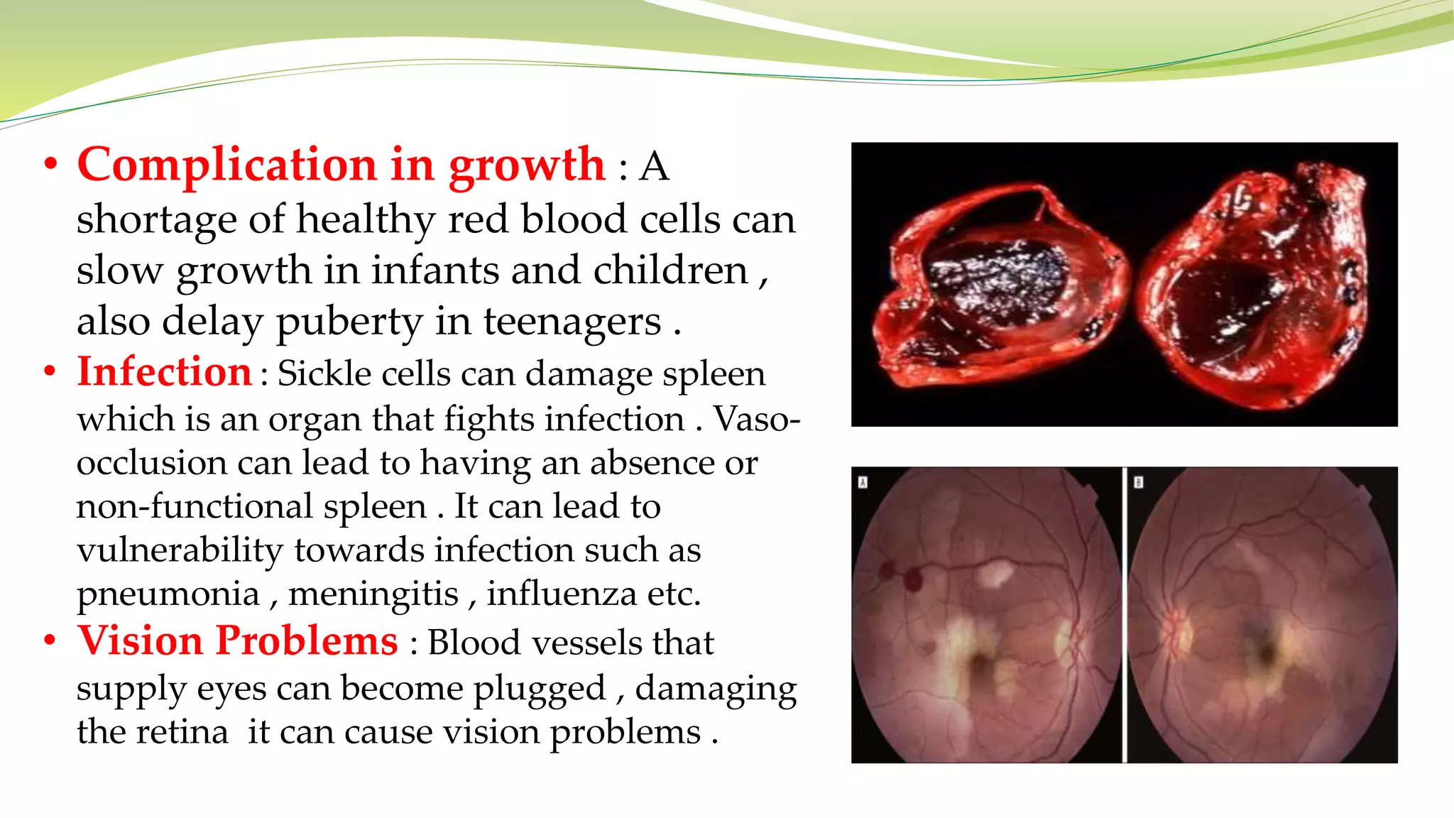 Presentation about sickle_cell_anemia_ | PPTX