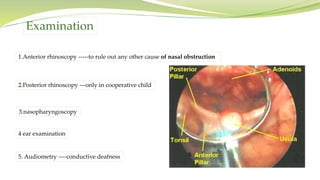 Presentation adenoidectomy | PPTX