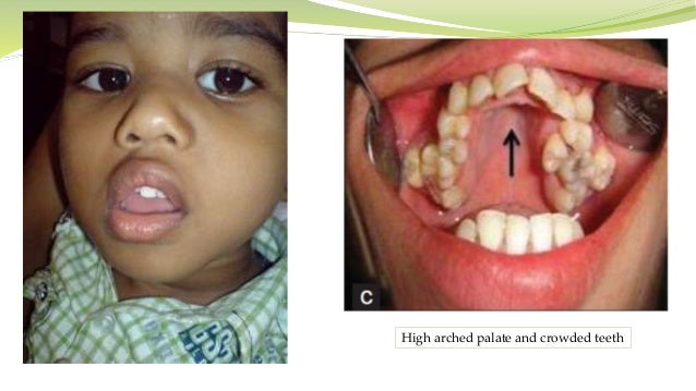 Presentation adenoidectomy