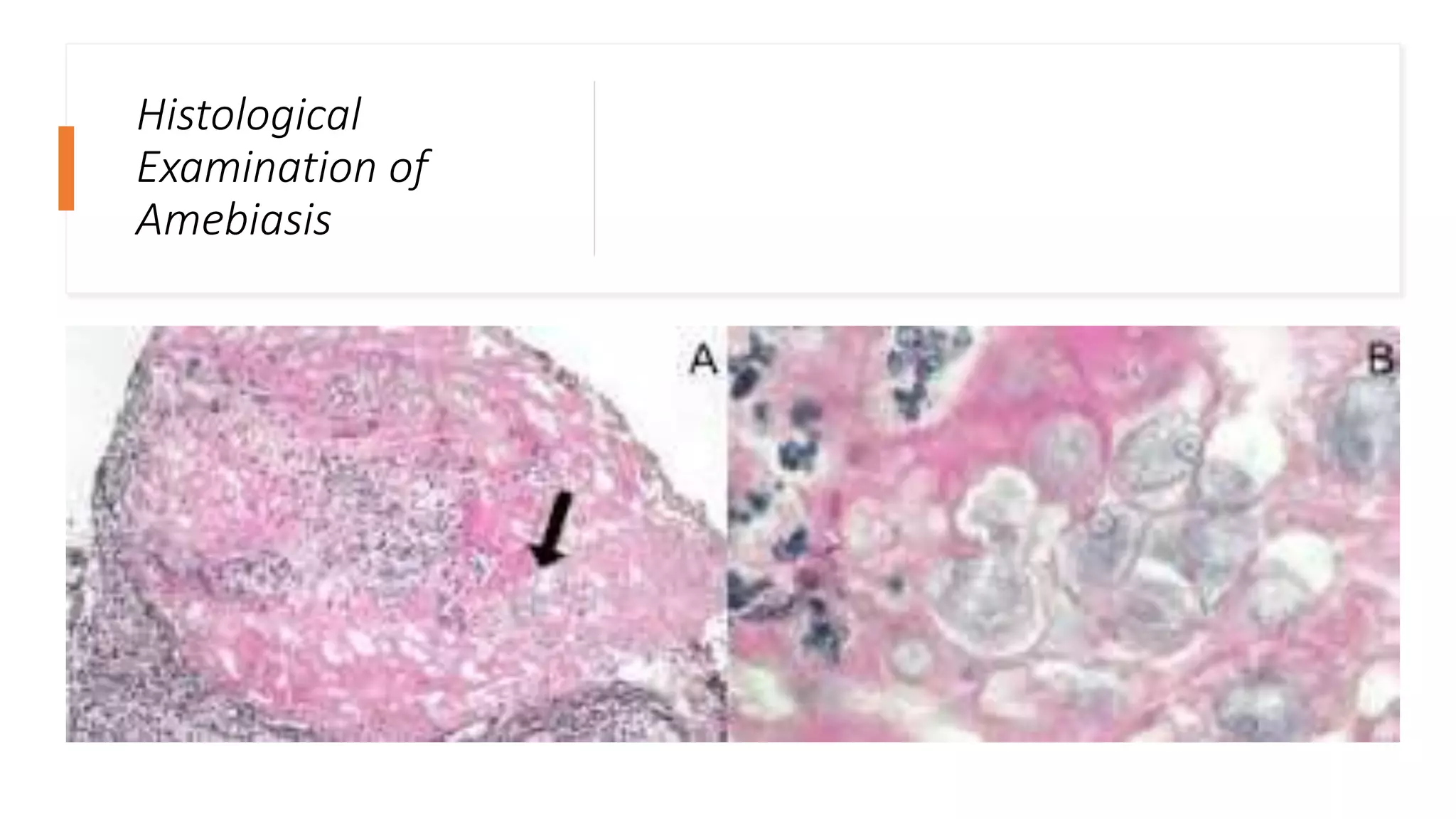 Amebiasis and Future perspective | PPT