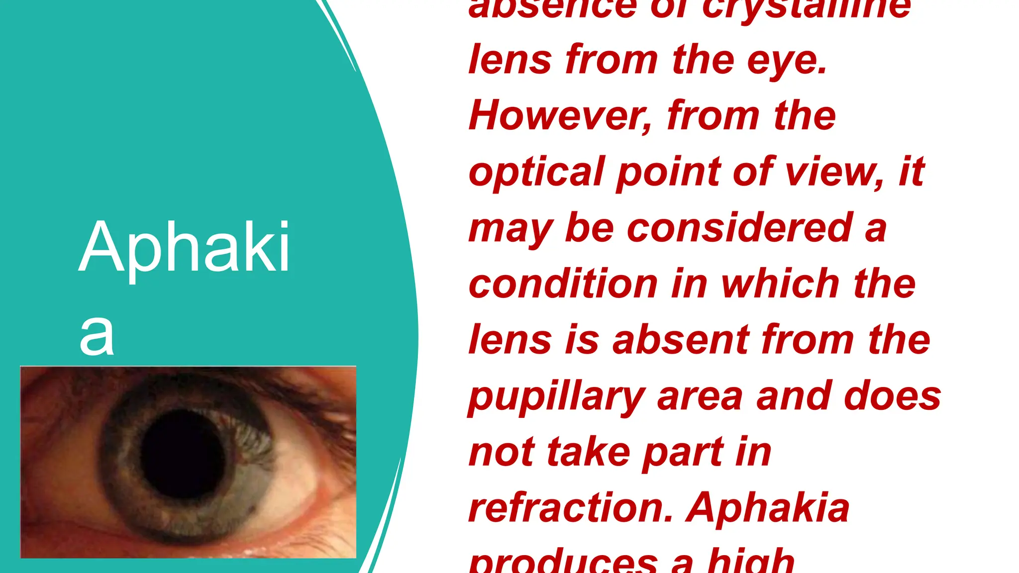 Presentation Aphakia ppt.pptxmmmmmmmmmmmmm | PPTX