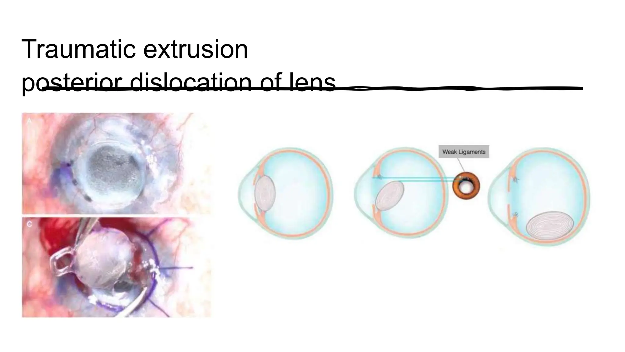 Presentation Aphakia ppt.pptxmmmmmmmmmmmmm | PPTX