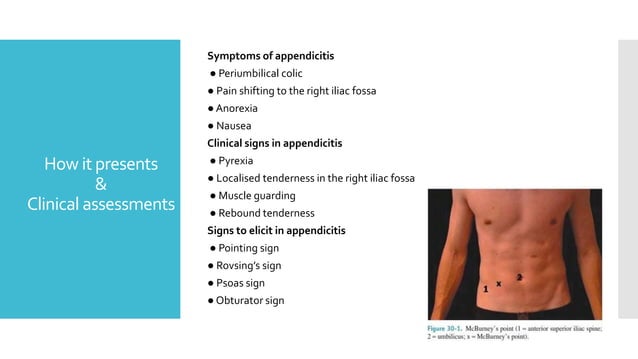 Acute appendicitis presentation.pptx