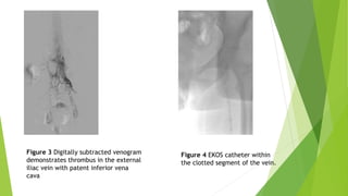 trombectomy | PPTX