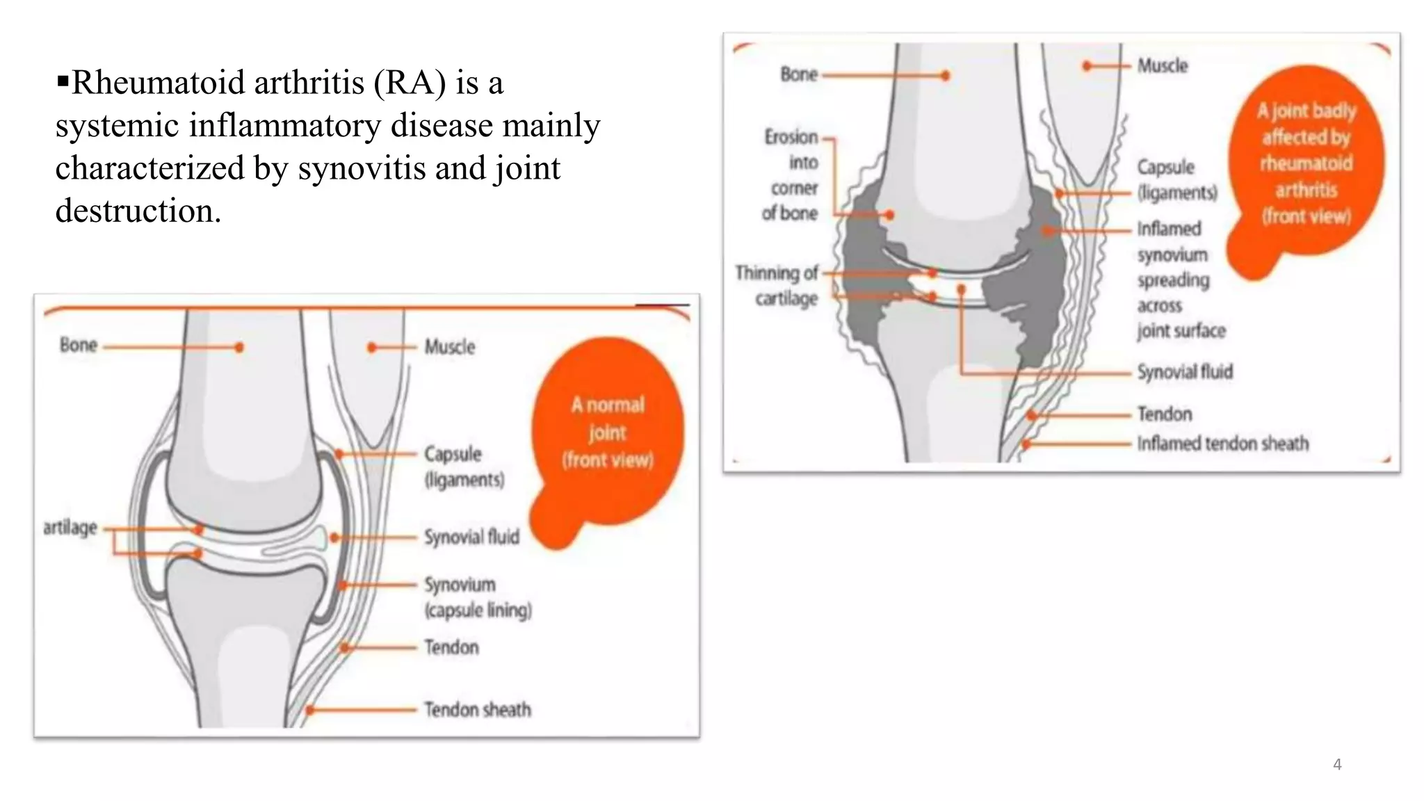 Rheumatoid arthritis and osteoarthritis presentation by Madhukar S ...