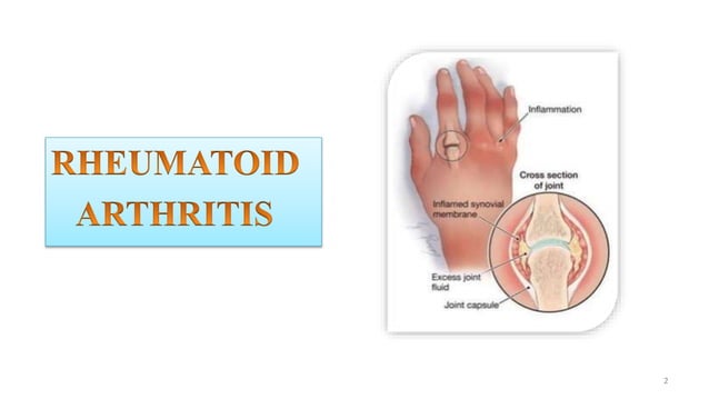 Rheumatoid arthritis and osteoarthritis presentation by Madhukar S ...