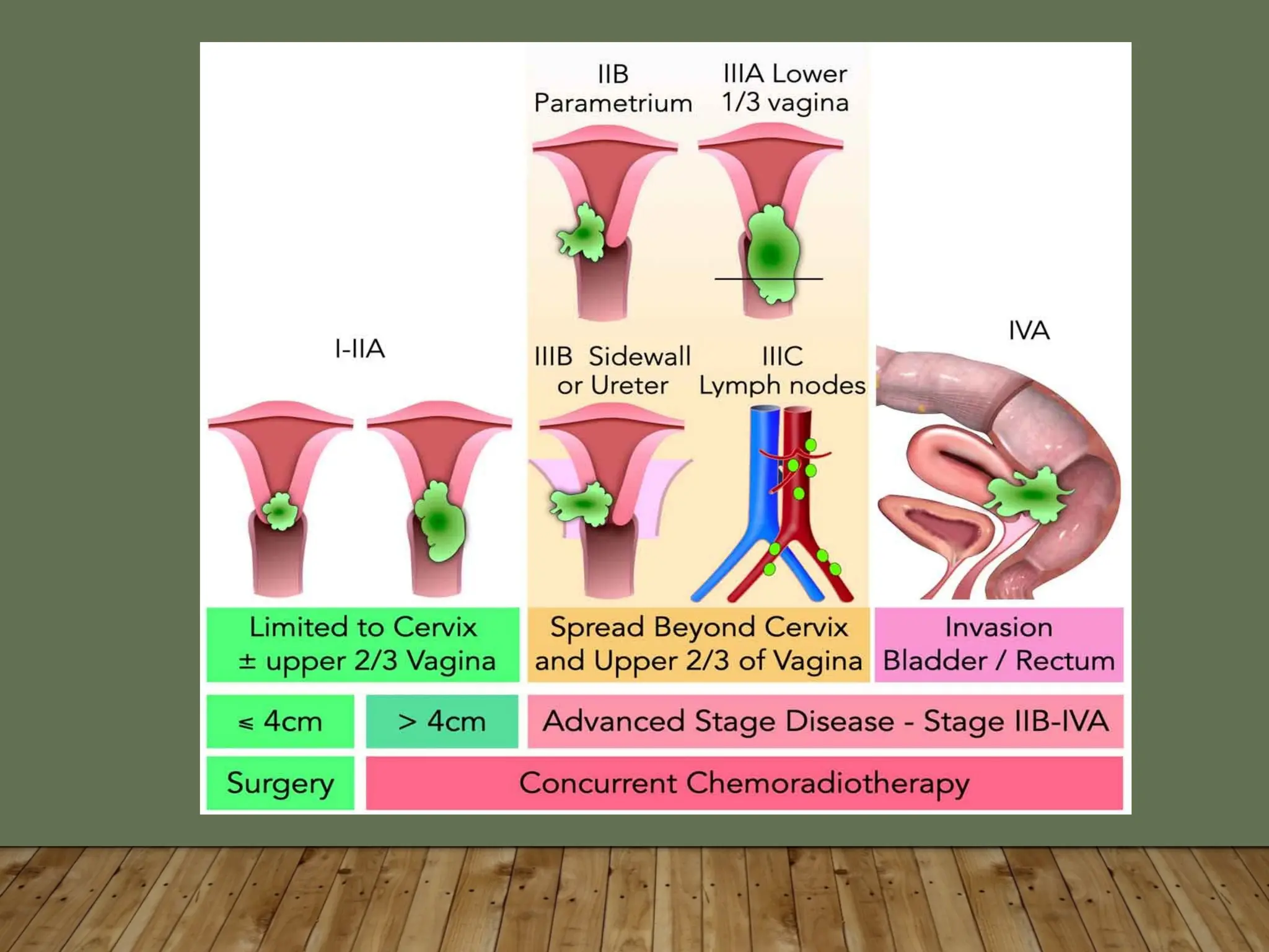 Carcinoma of cervix for undergraduates.ppt