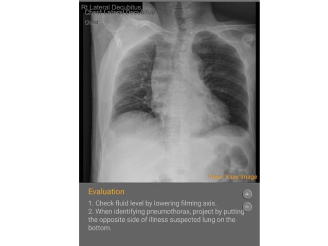Presentation chest.pptx x ray positioning of chest | PPT
