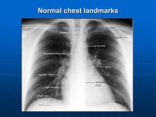 presentation chest X-ray 2.ppt