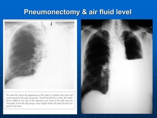 presentation chest X-ray 2.ppt