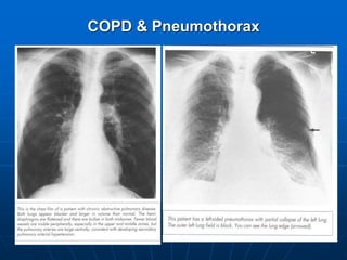 presentation chest X-ray 2.ppt