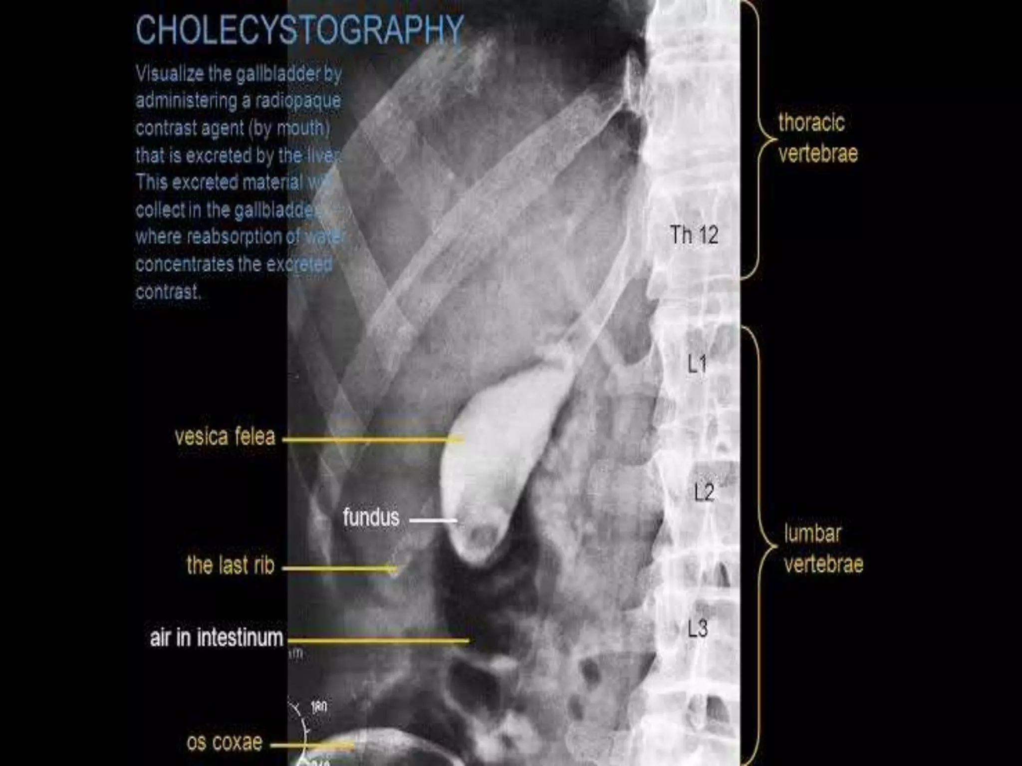 Presentation cholelithiasis | PPTX
