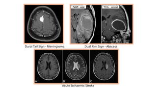Management of brain and spine metastases including surgery and ...