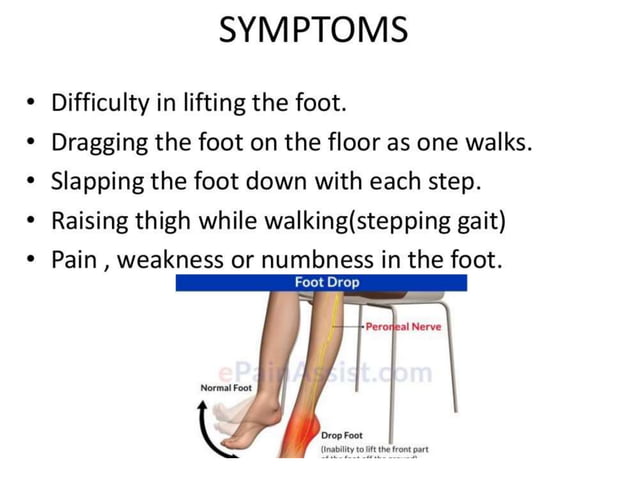 Presentationcommon%20peroneal%20nerve%20injury.pptx