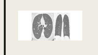 Chronic airflow obstruction | PPTX