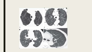 Chronic airflow obstruction | PPTX