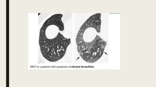 Chronic airflow obstruction | PPTX