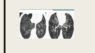 Chronic airflow obstruction | PPTX
