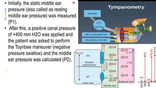 Eustachian tube dysfunction, a journal Club presentation | PPTX
