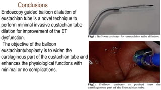Eustachian tube dysfunction, a journal Club presentation | PPTX ...