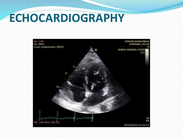 Constrictive Pericarditis