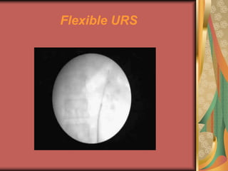 Endourology.ppt