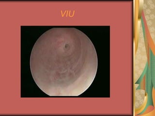 Endourology.ppt