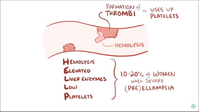 Presentation__eclampsia.pptx