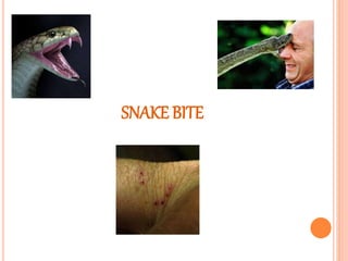 Bites and Stings emergency medicine | PPTX