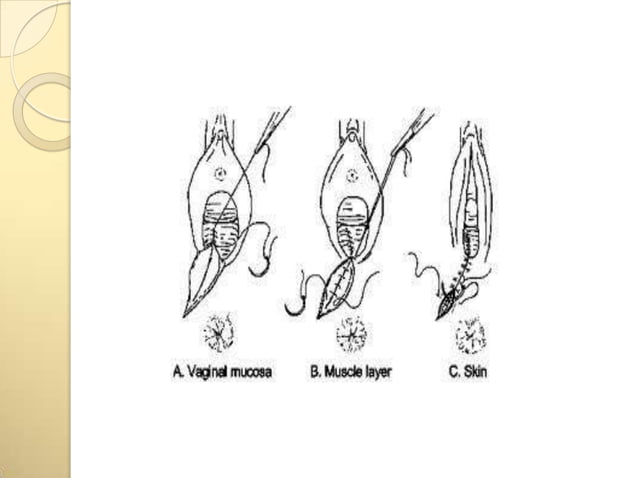 Presentation episiotomy