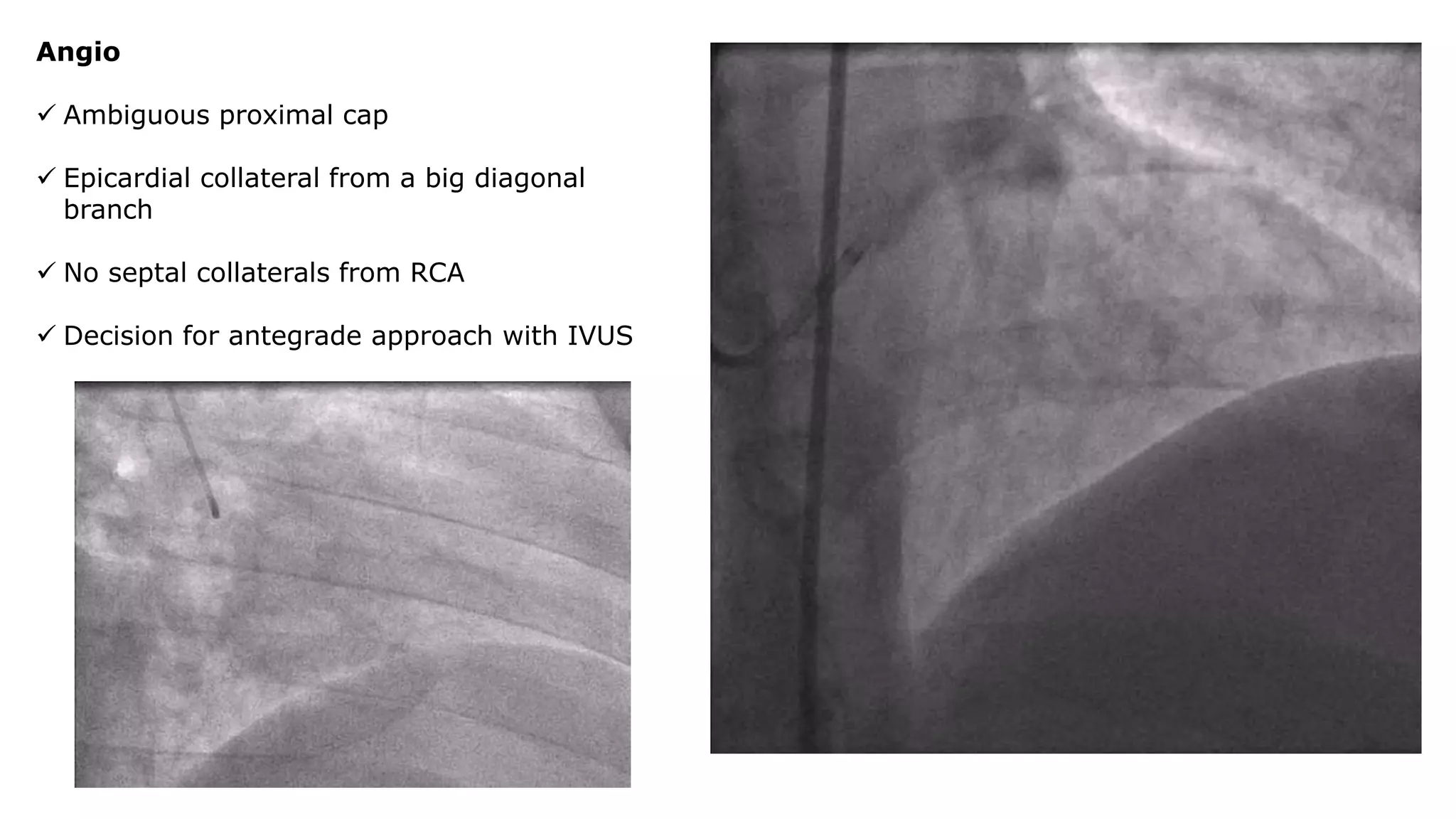 39 year old patient with mid-LAD CTO – successful IVUS-guided puncture of the proximal cap | PPT