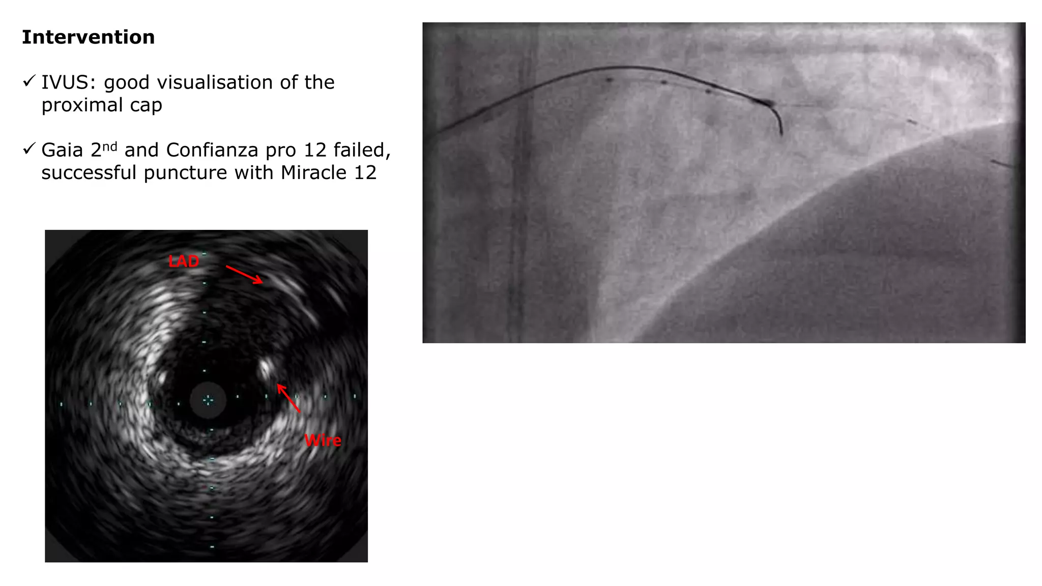 39 year old patient with mid-LAD CTO – successful IVUS-guided puncture of the proximal cap | PPT
