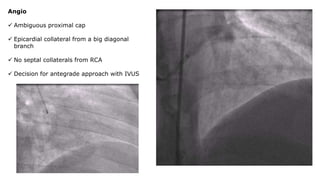 39 year old patient with mid-LAD CTO – successful IVUS-guided puncture ...